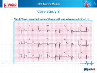 Ecg basics and interpretation | PPTX
