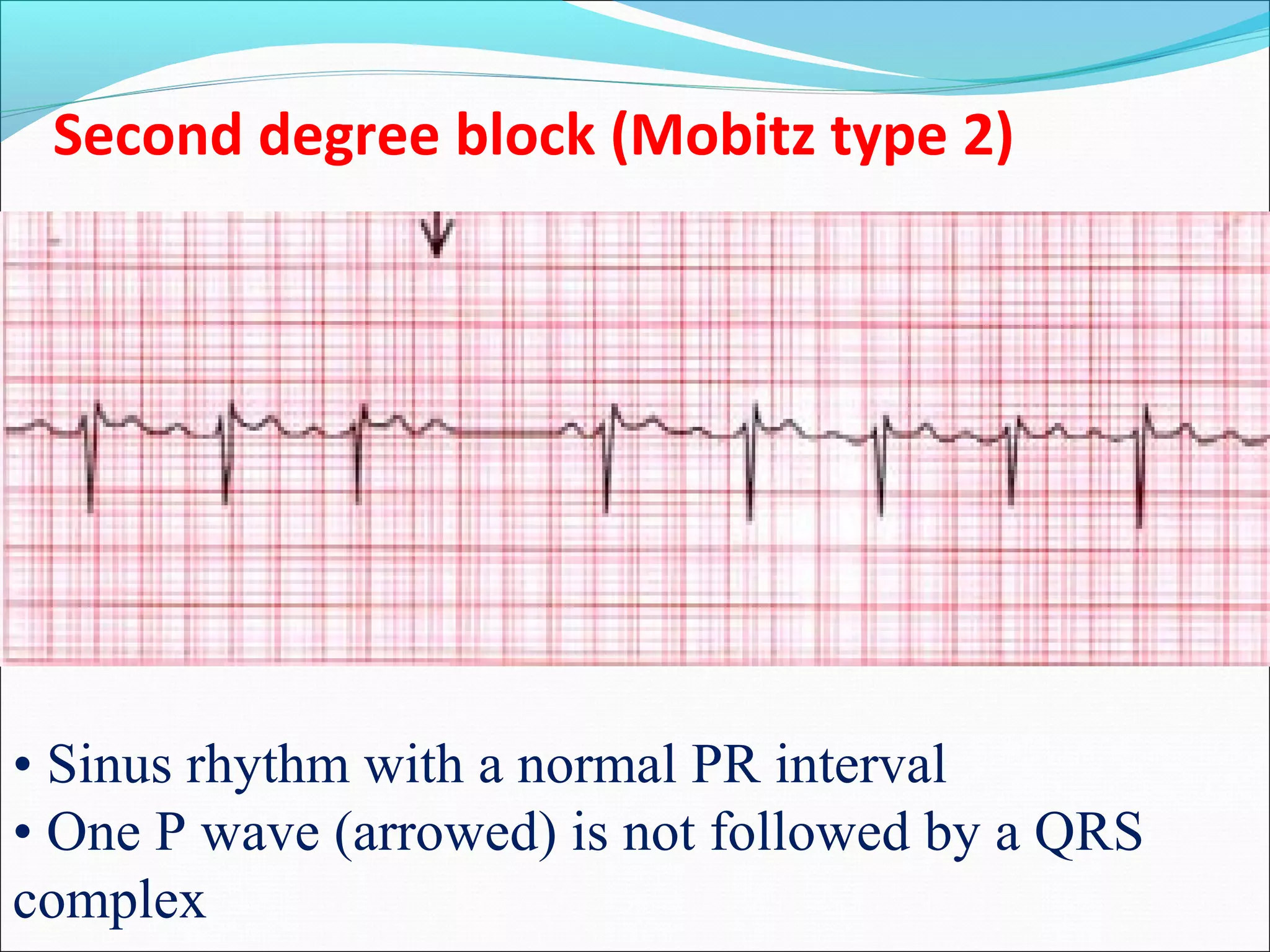 Ecg basics conduction tissue | PPT
