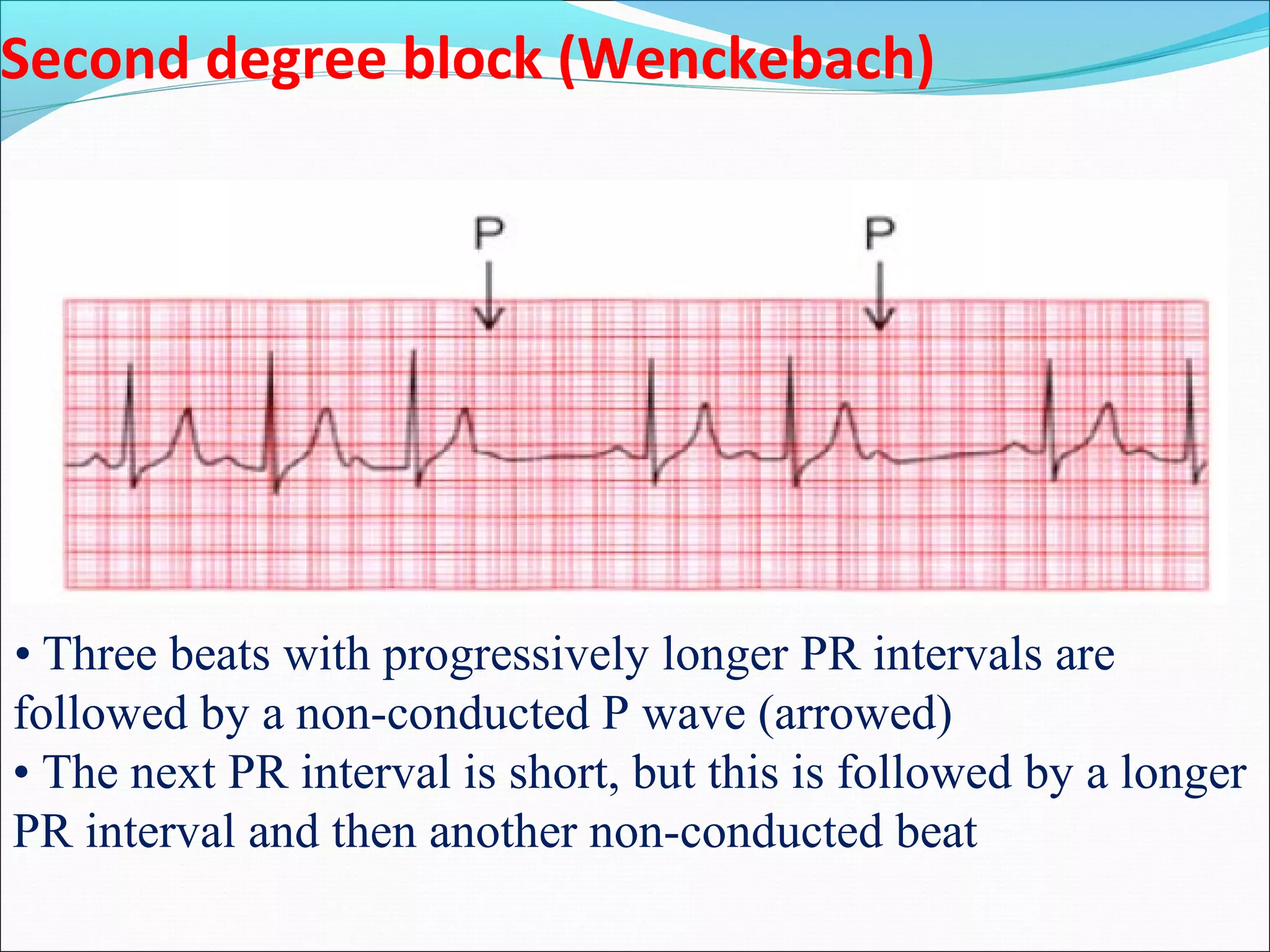 Ecg basics conduction tissue | PPT