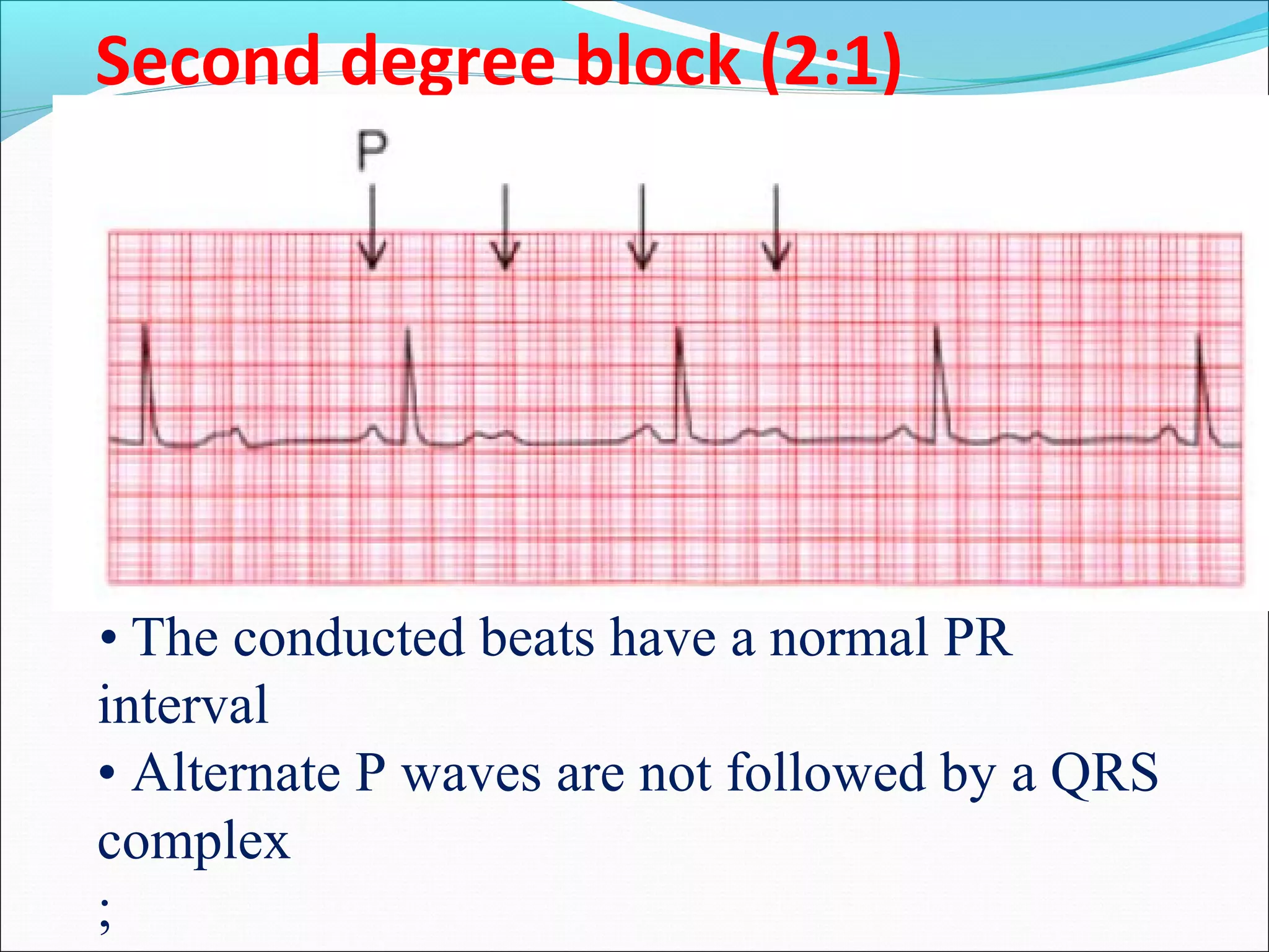 Ecg basics conduction tissue | PPT