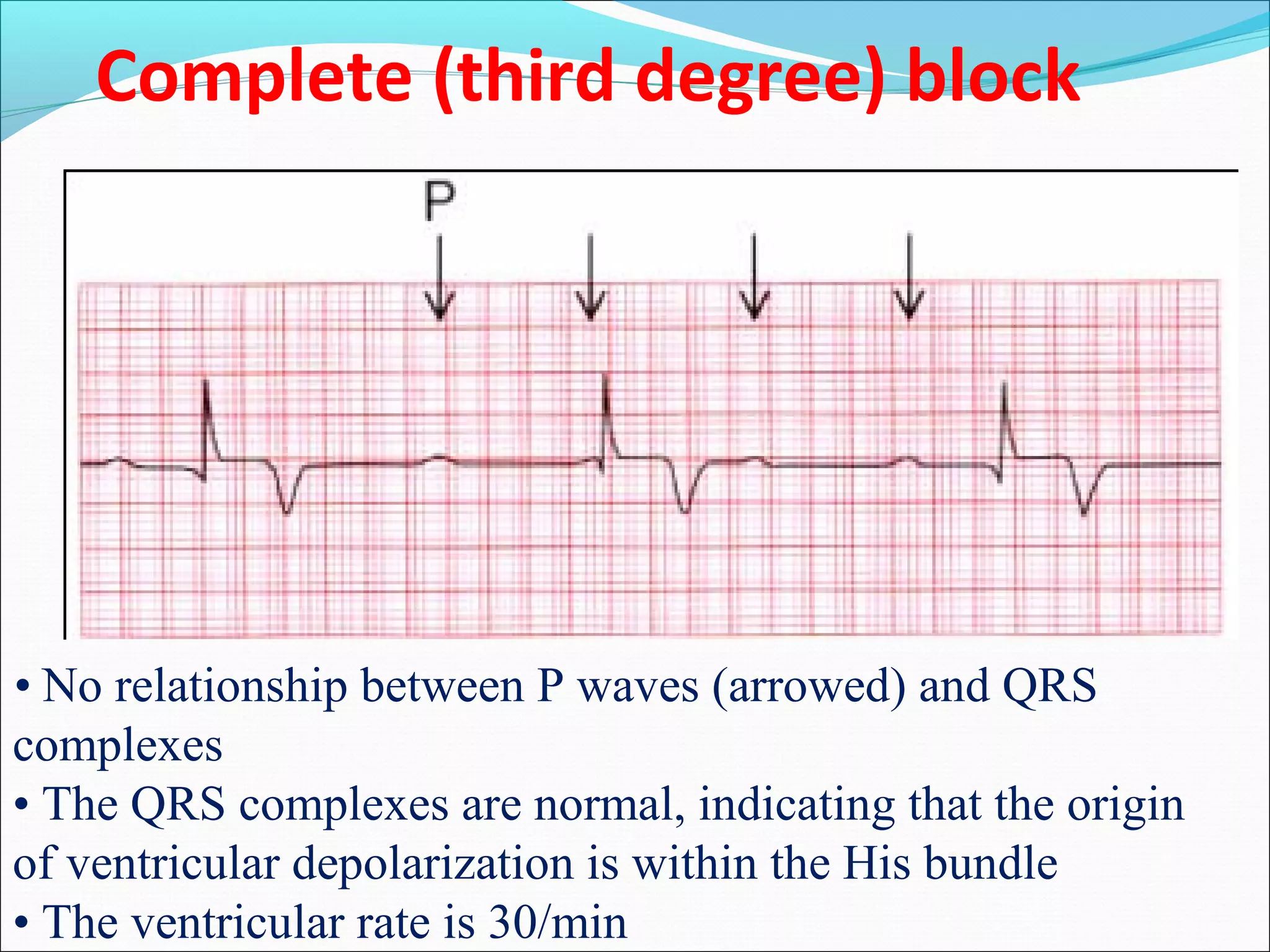 Ecg basics conduction tissue | PPT