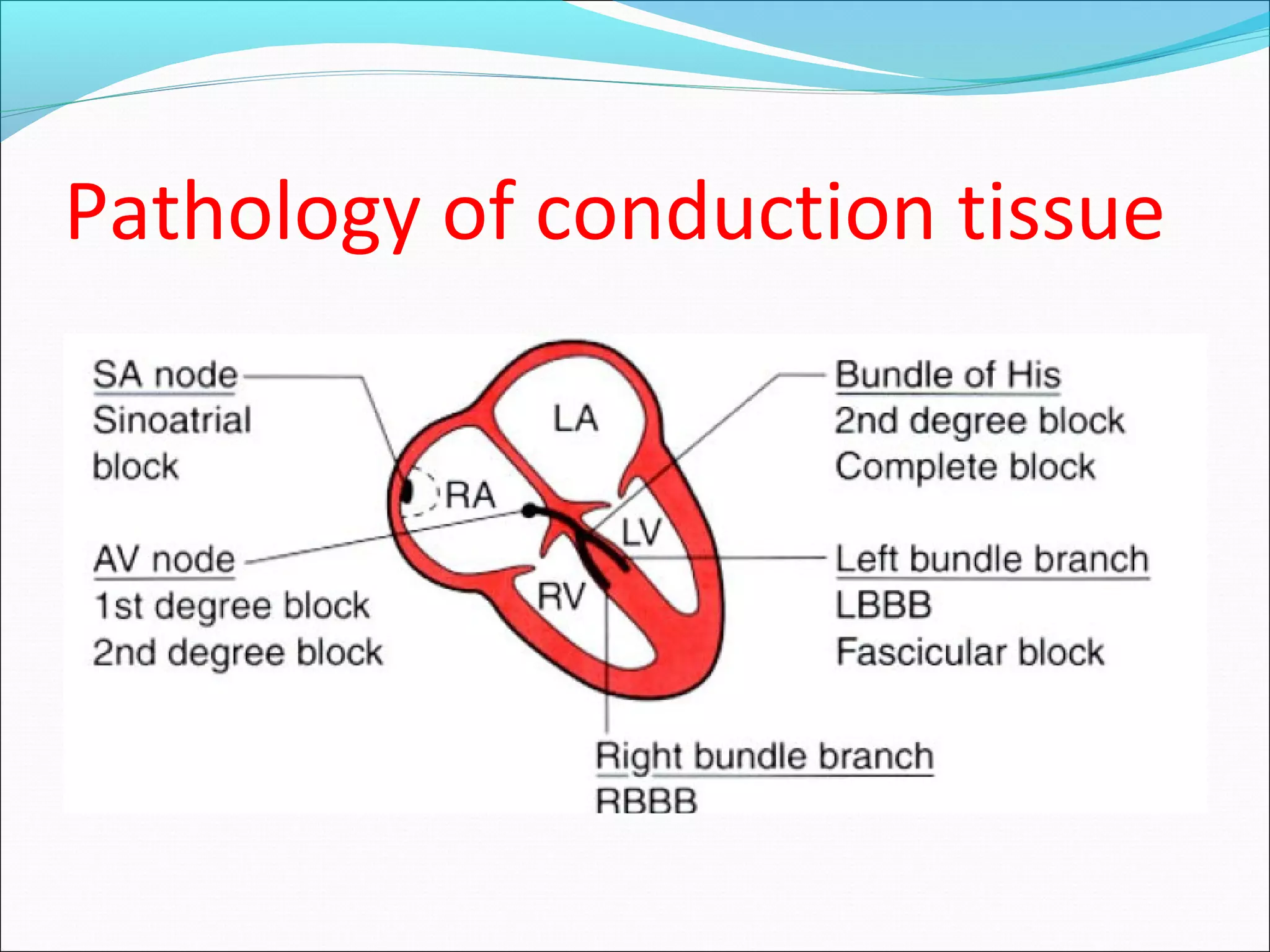 Ecg basics conduction tissue | PPT