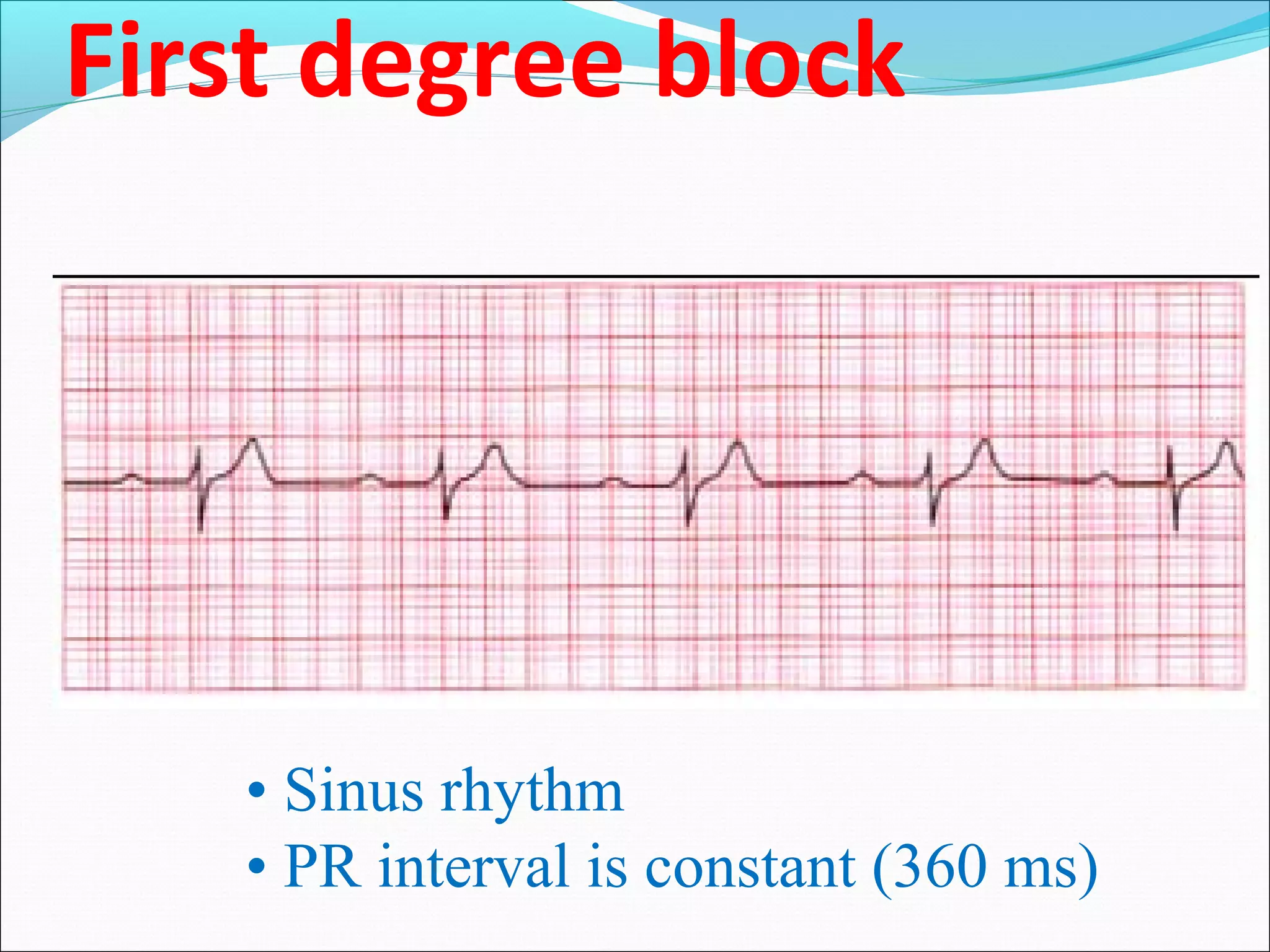 Ecg basics conduction tissue | PPT