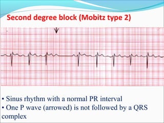 Ecg basics conduction tissue | PPT