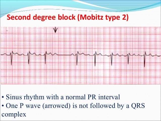 Ecg basics conduction tissue