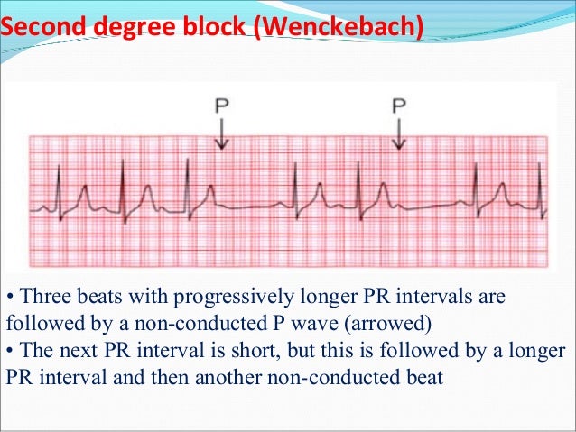 Ecg basics conduction tissue