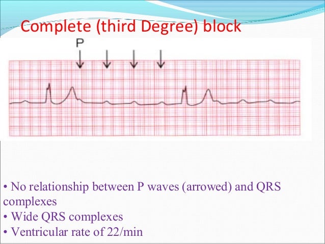 Ecg basics conduction tissue