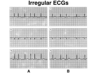 Abnormal Ecg Labeled