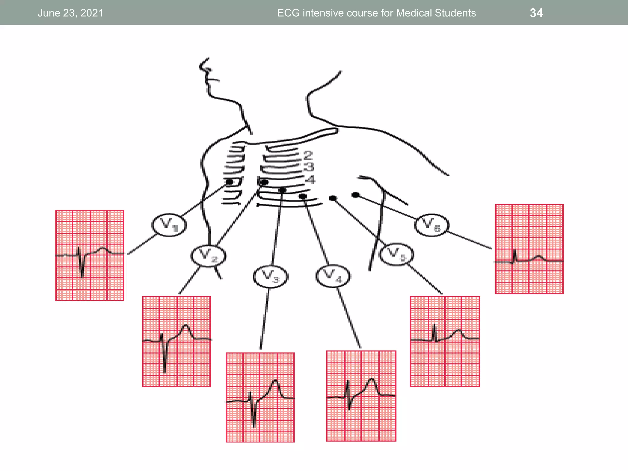 ECG Basics Lecture 2 | PPT