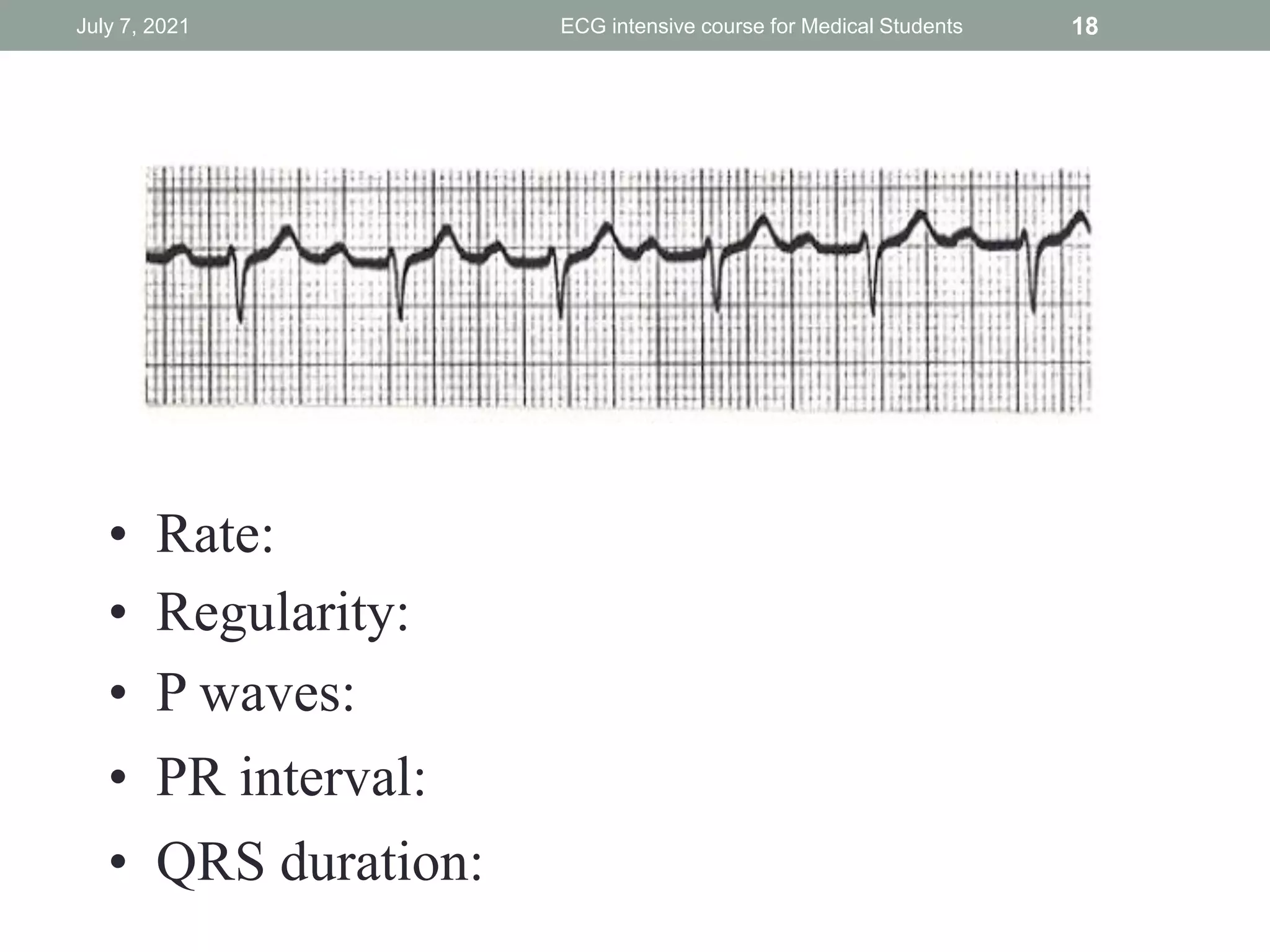 Ecg basics lecture 4 | PPT