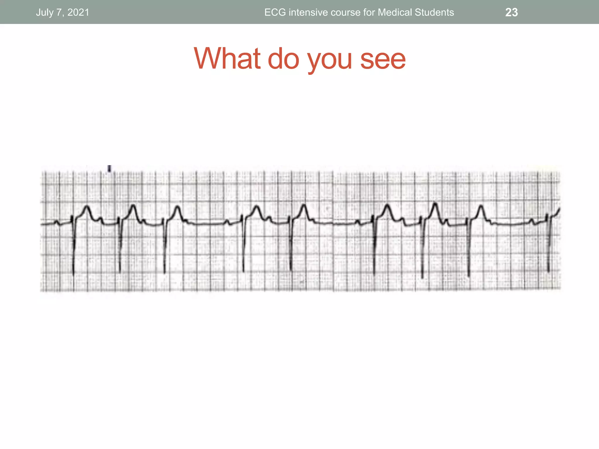 Ecg basics lecture 4 | PPT