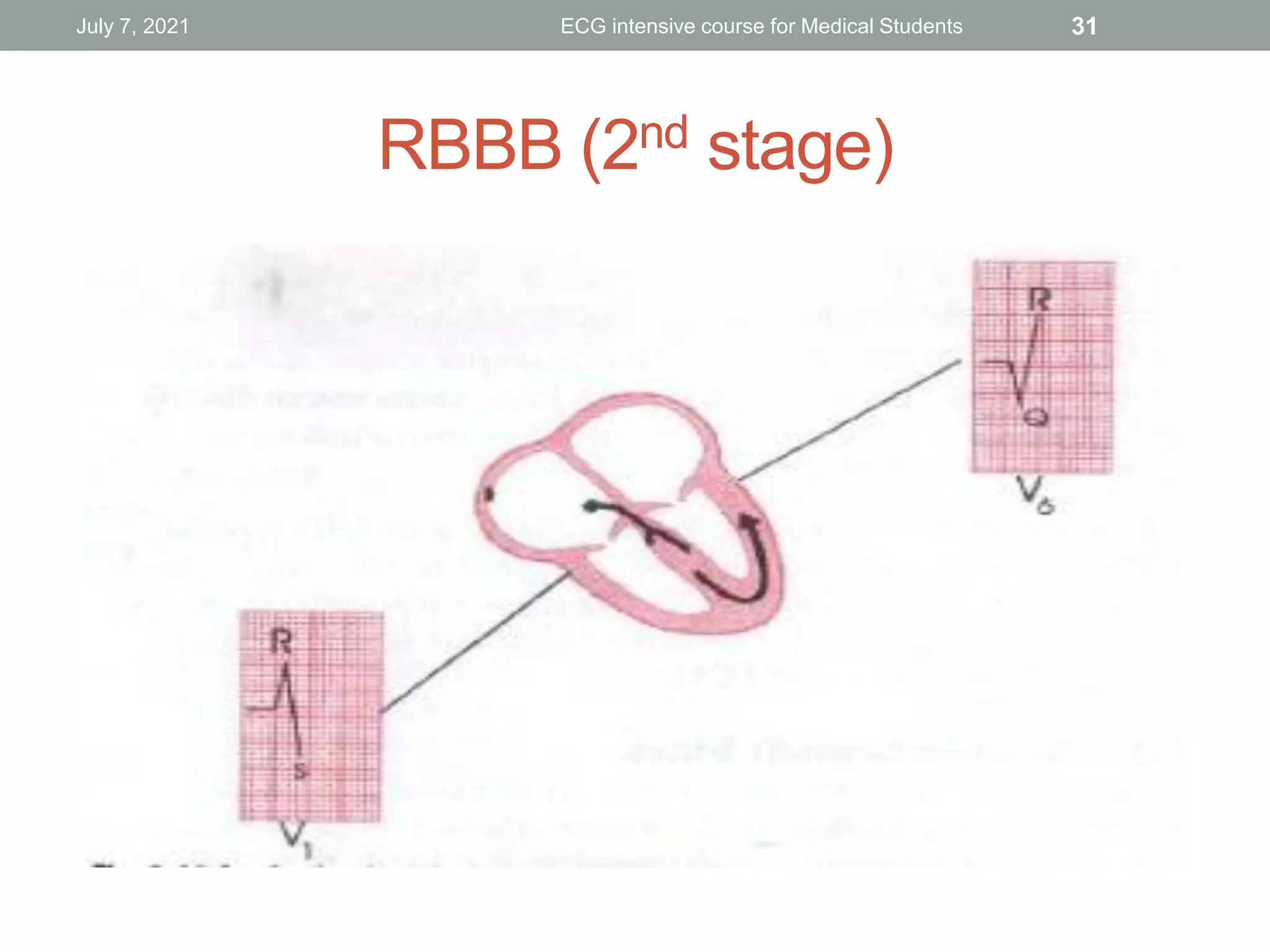 Ecg basics lecture 4 | PPT