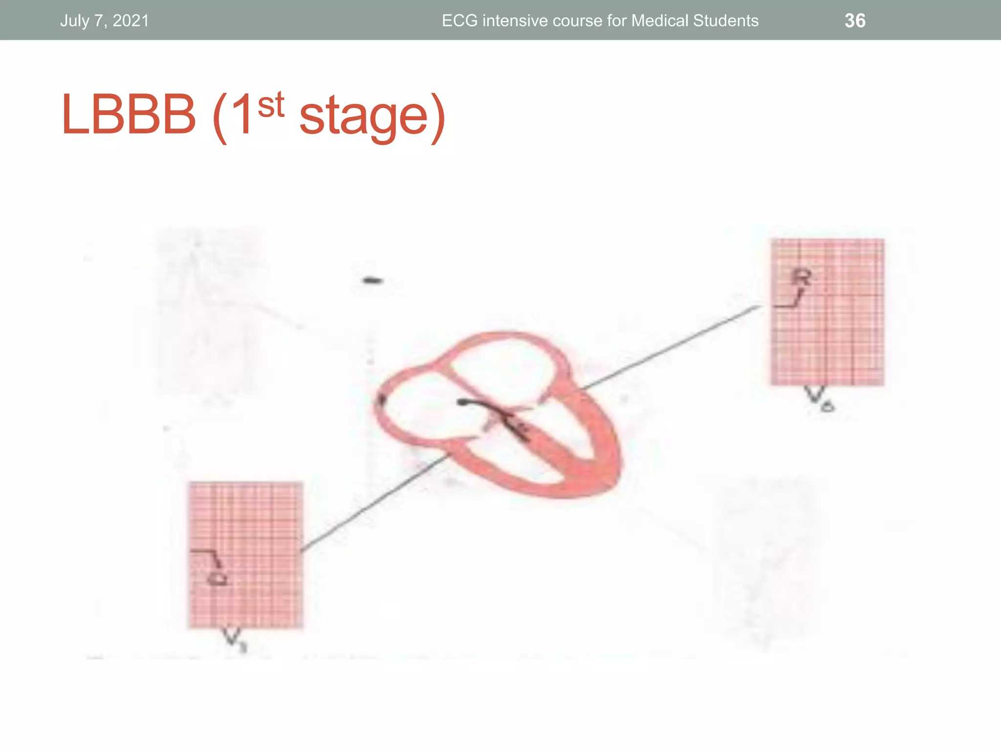 Ecg basics lecture 4 | PPT