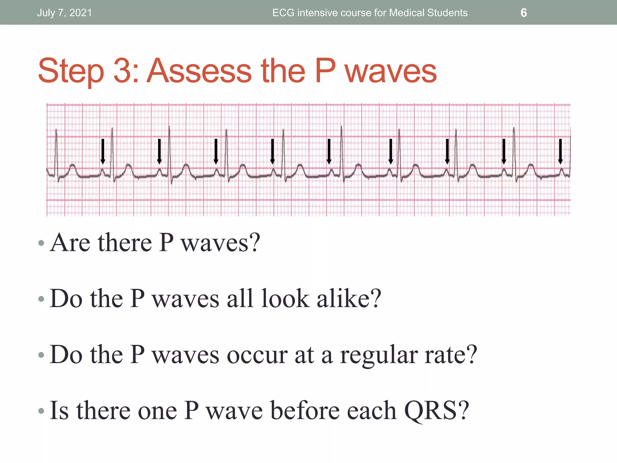 Ecg basics lecture 4 | PPT