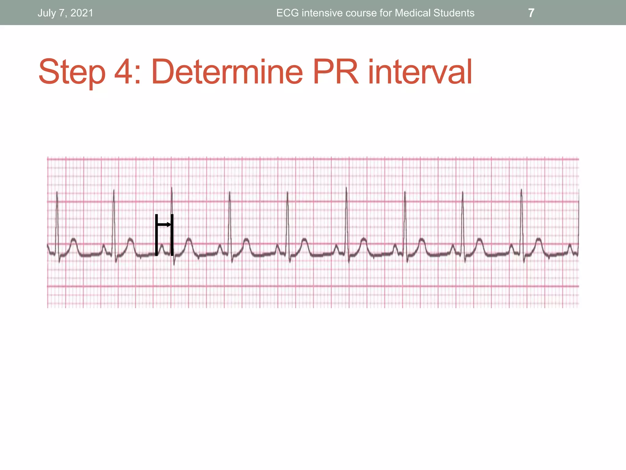 Ecg basics lecture 4 | PPT