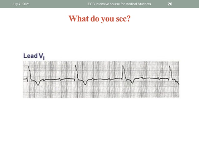 Ecg basics lecture 4 | PPT