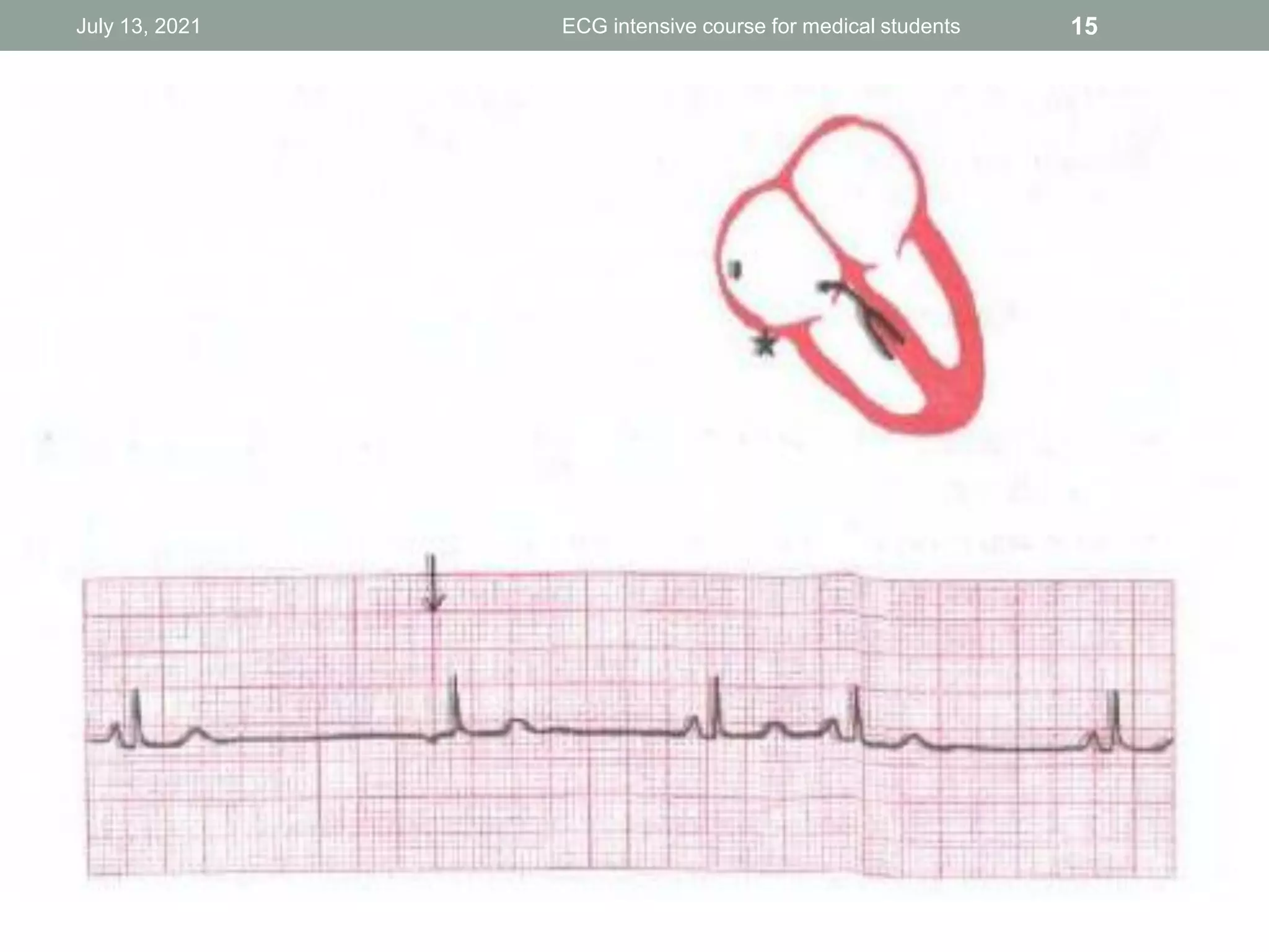 Ecg basics lecture 6 | PDF