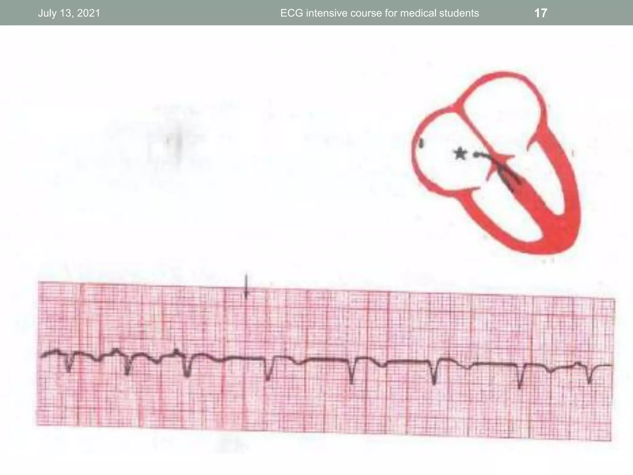 Ecg basics lecture 6 | PDF