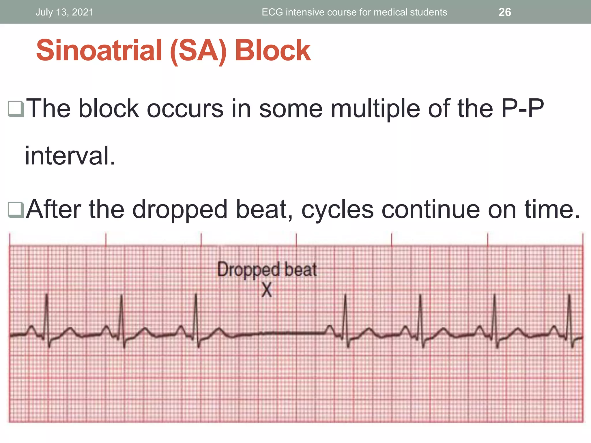 Ecg basics lecture 6 | PDF