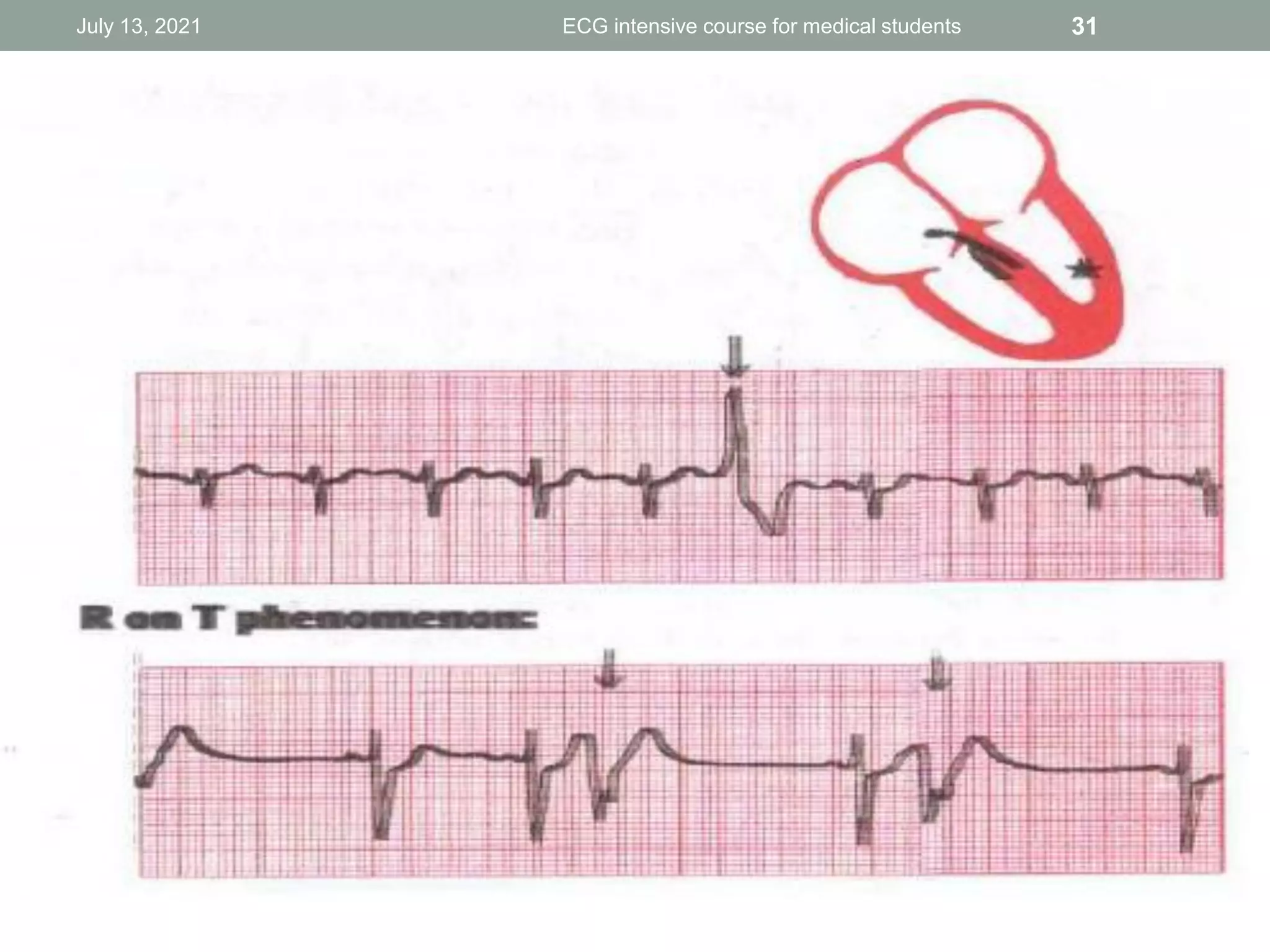 Ecg basics lecture 6 | PDF