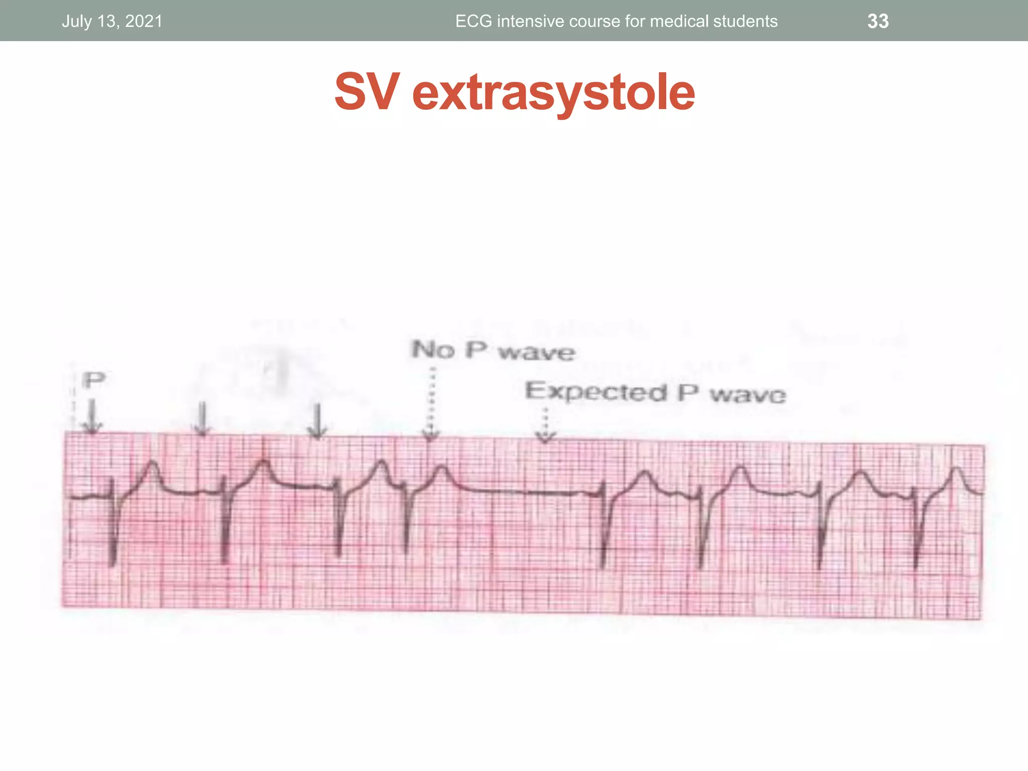 Ecg basics lecture 6 | PDF