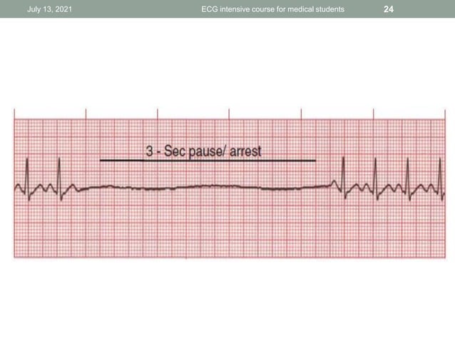 Ecg basics lecture 6 | PPT