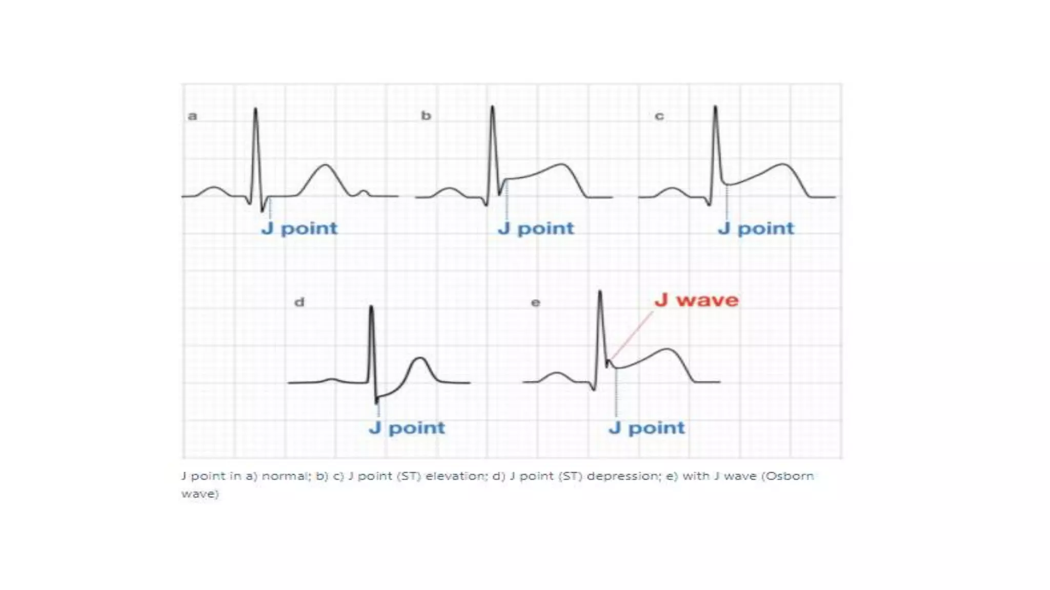 ECG BASICS PRESENTATION .pptx