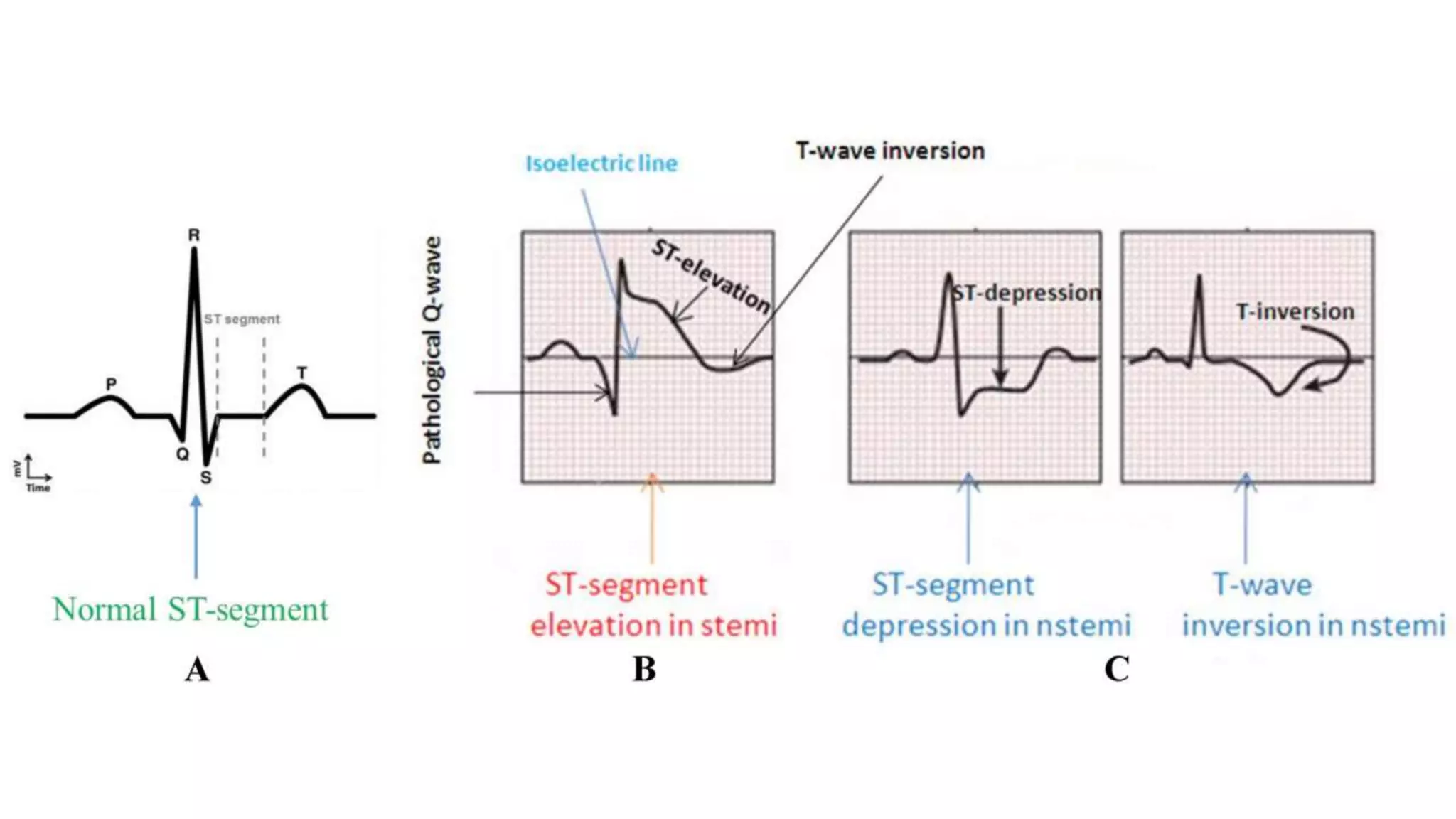 ECG BASICS PRESENTATION .pptx