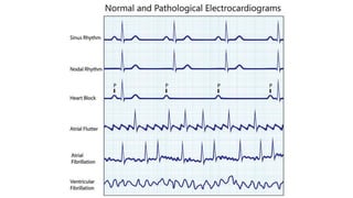 ECG BASICS PRESENTATION .pptx