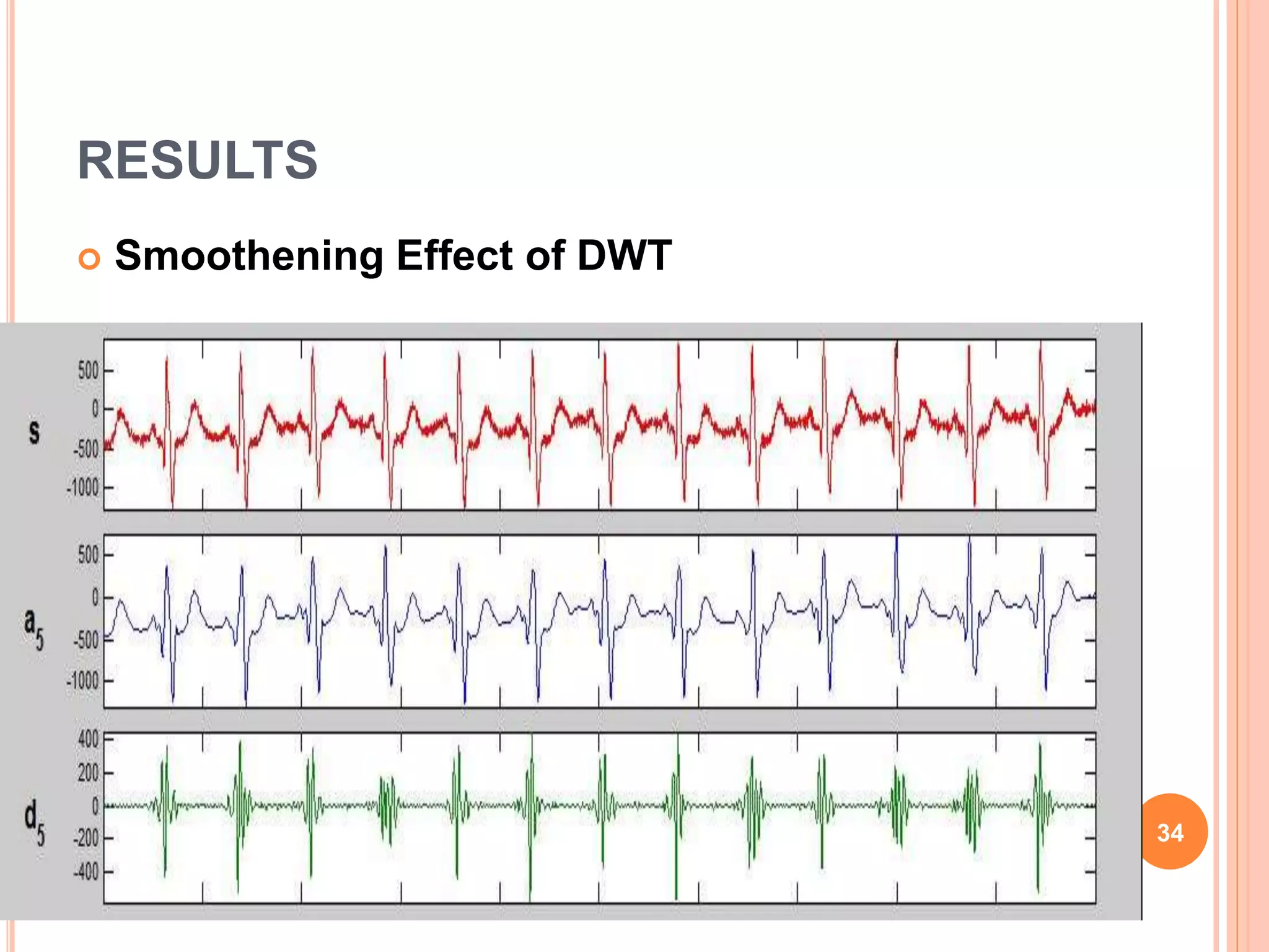 Ecg Beat Classification And Feature Extraction Using Artificial Neural Network And Discrete