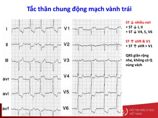 Ecg benh mach vanh | PDF