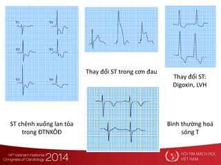 Ecg benh mach vanh | PDF