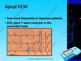 ECG C | PPSX