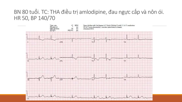 ECG Cap cuu (1).pptx