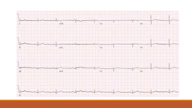 ECG Cap cuu (1).pptx