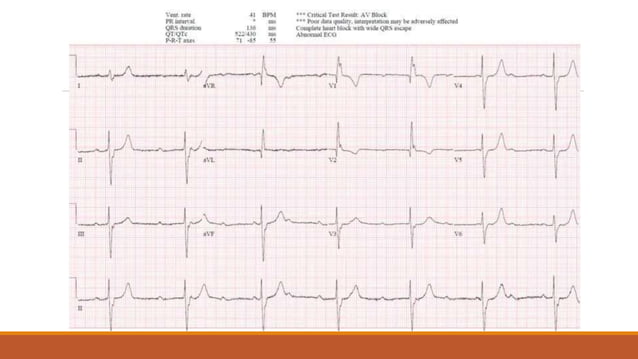 ECG Cap cuu (1).pptx