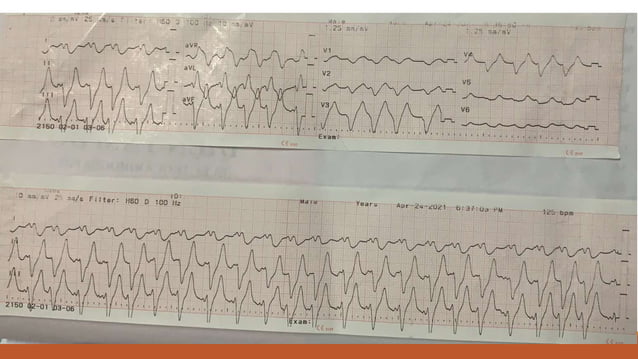 ECG Cap cuu (1).pptx
