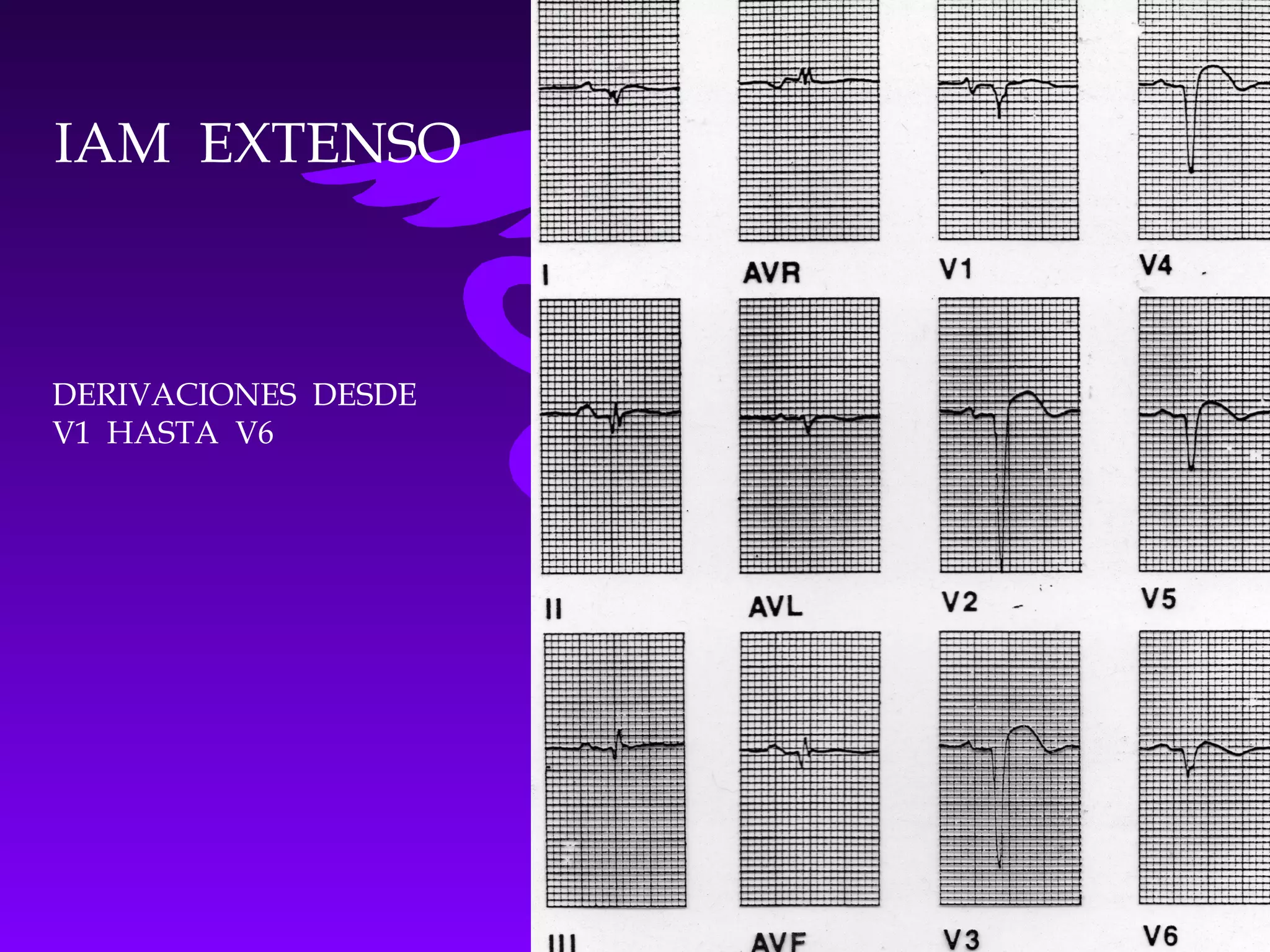 Cambios ECG en cardiopatía isquemica | PPT | Heart and Cardiovascular ...