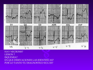 Cambios ECG en cardiopatía isquemica | PPT
