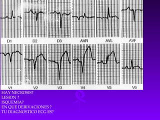 Cambios ECG en cardiopatía isquemica | PPT