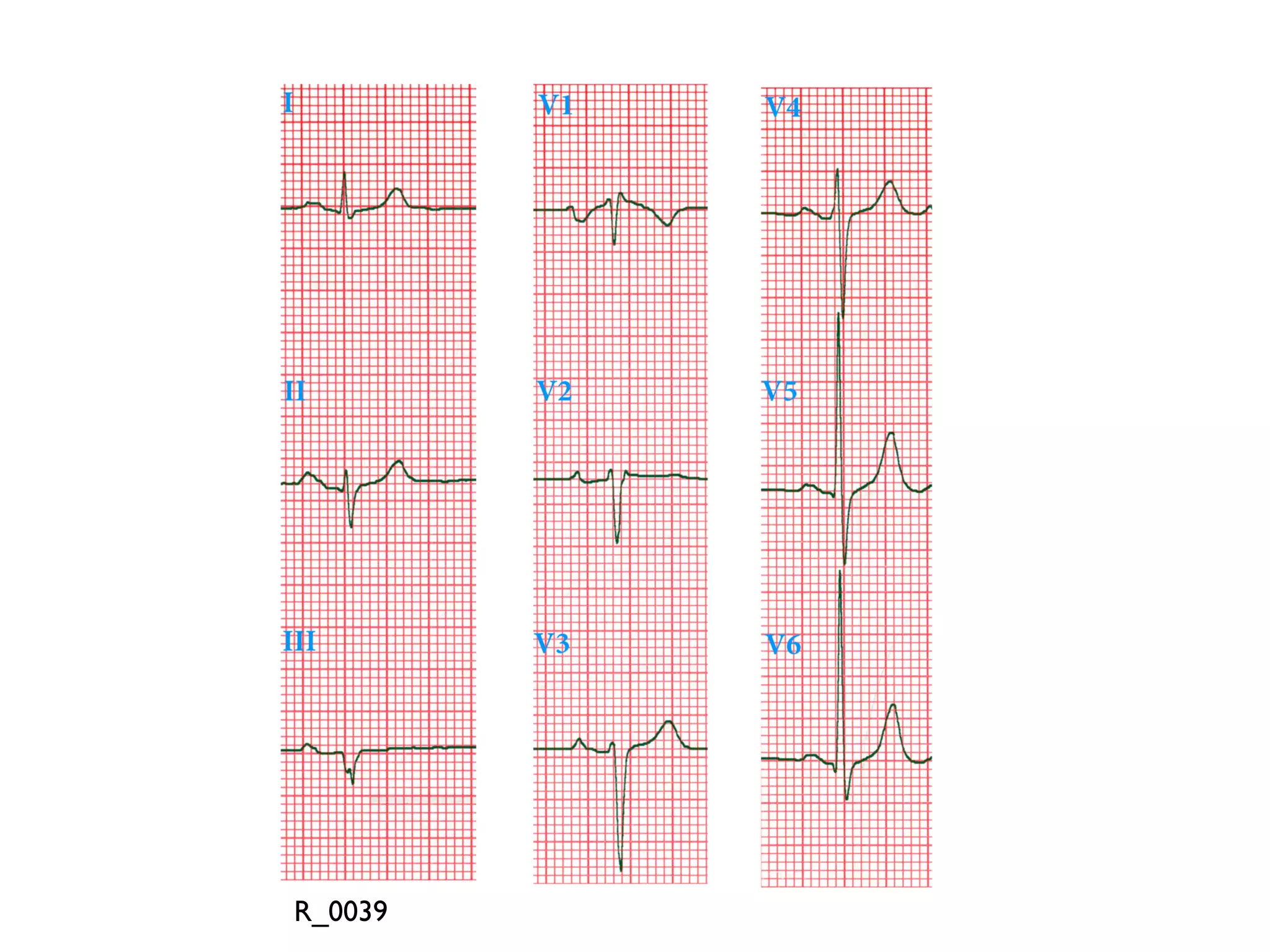 LD ECG Talk March 2016 | PDF