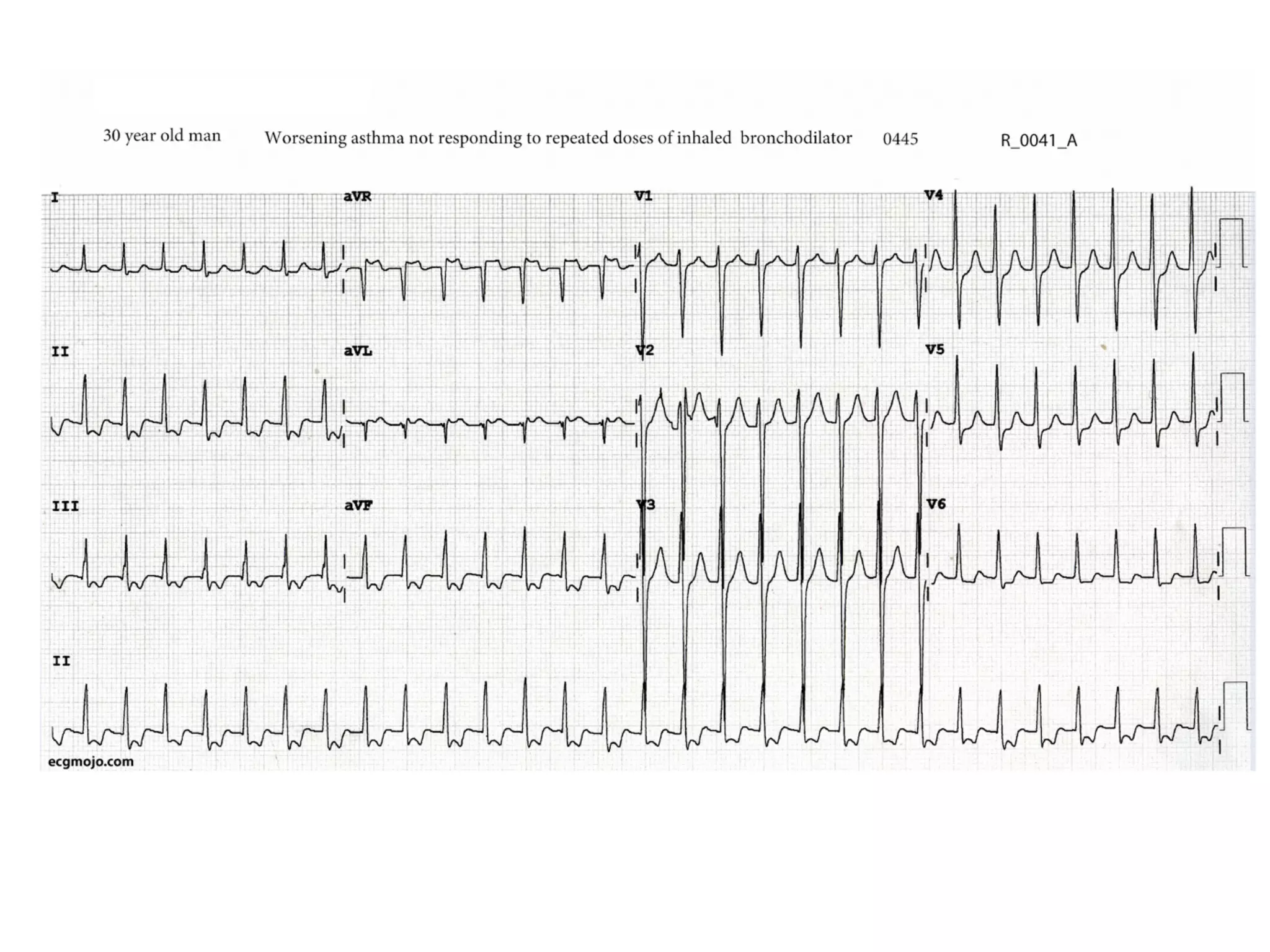 LD ECG Talk March 2016 | PDF