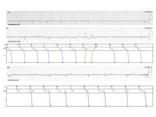 LD ECG Talk March 2016 | PDF