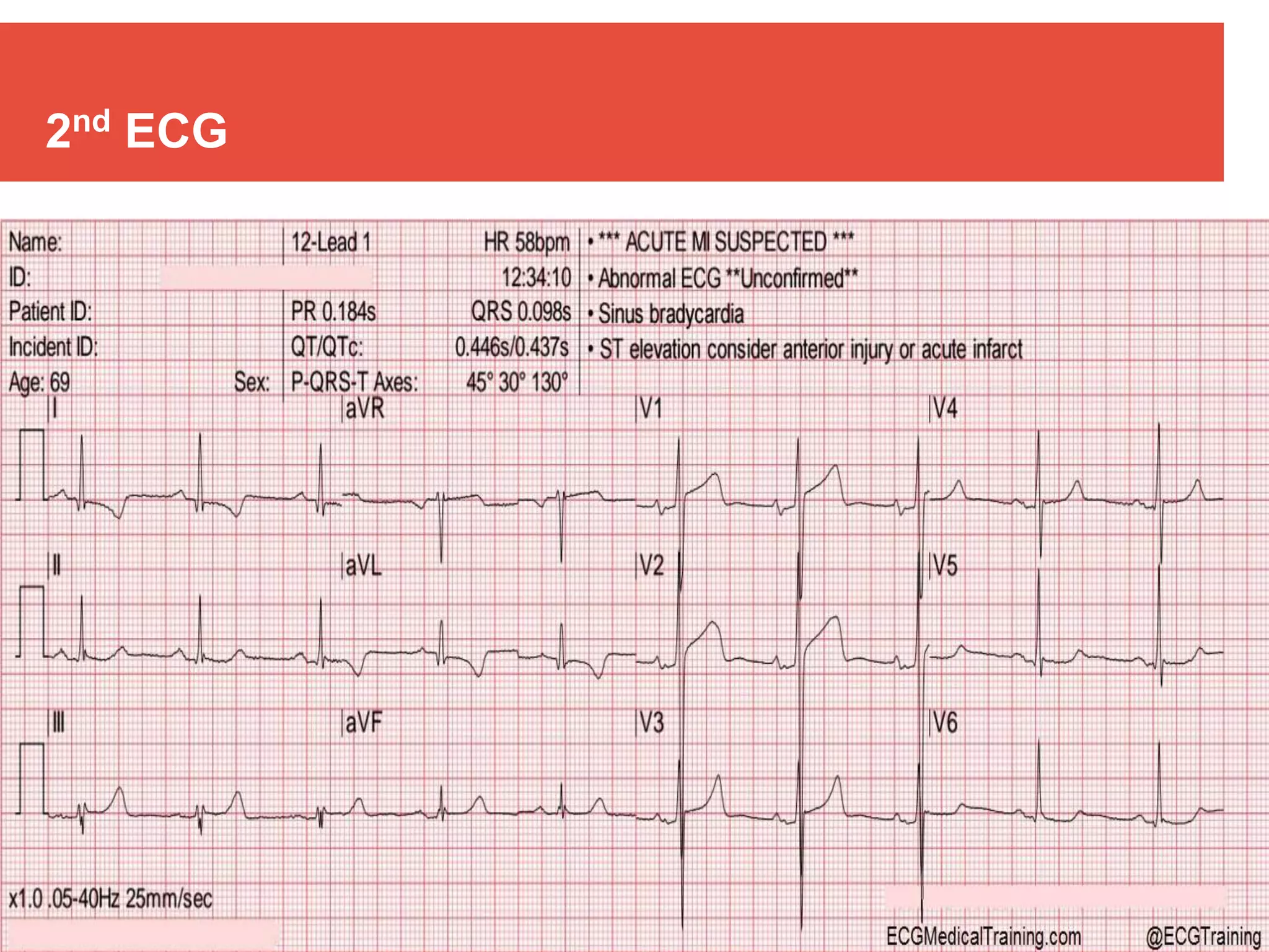 Ecg challenges | PPT