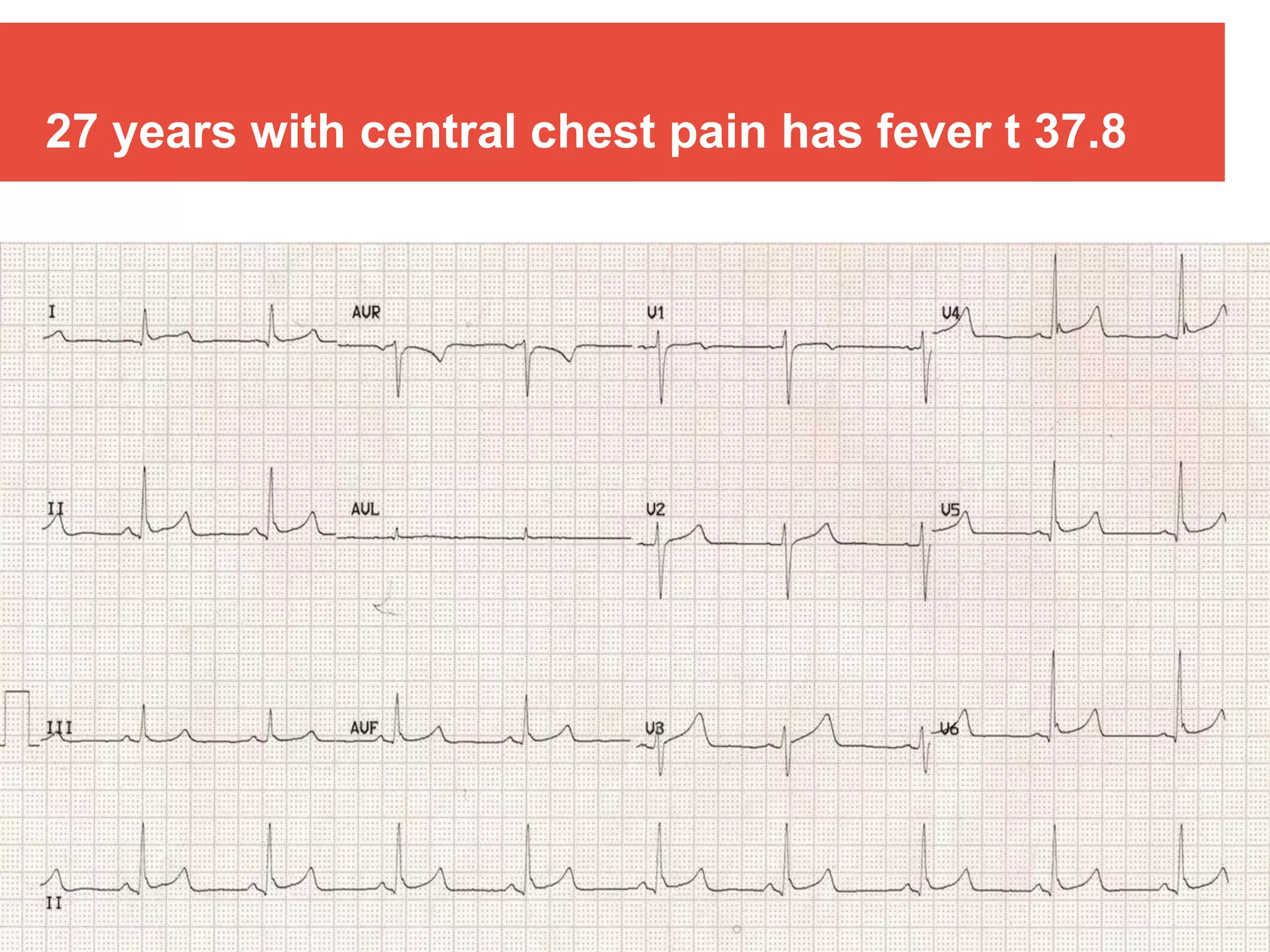 Ecg challenges | PPT