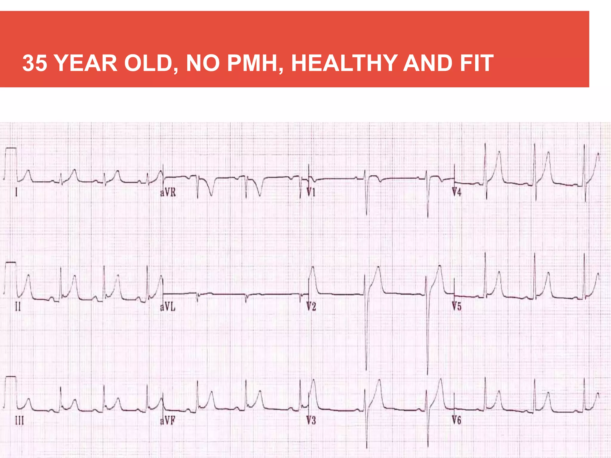 Ecg challenges | PPTX