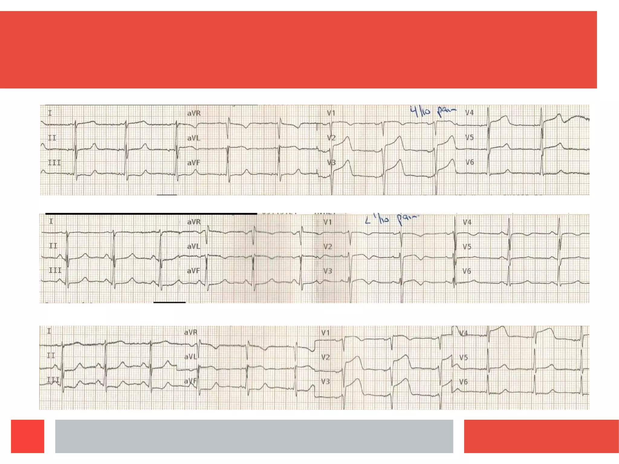Ecg challenges | PPTX