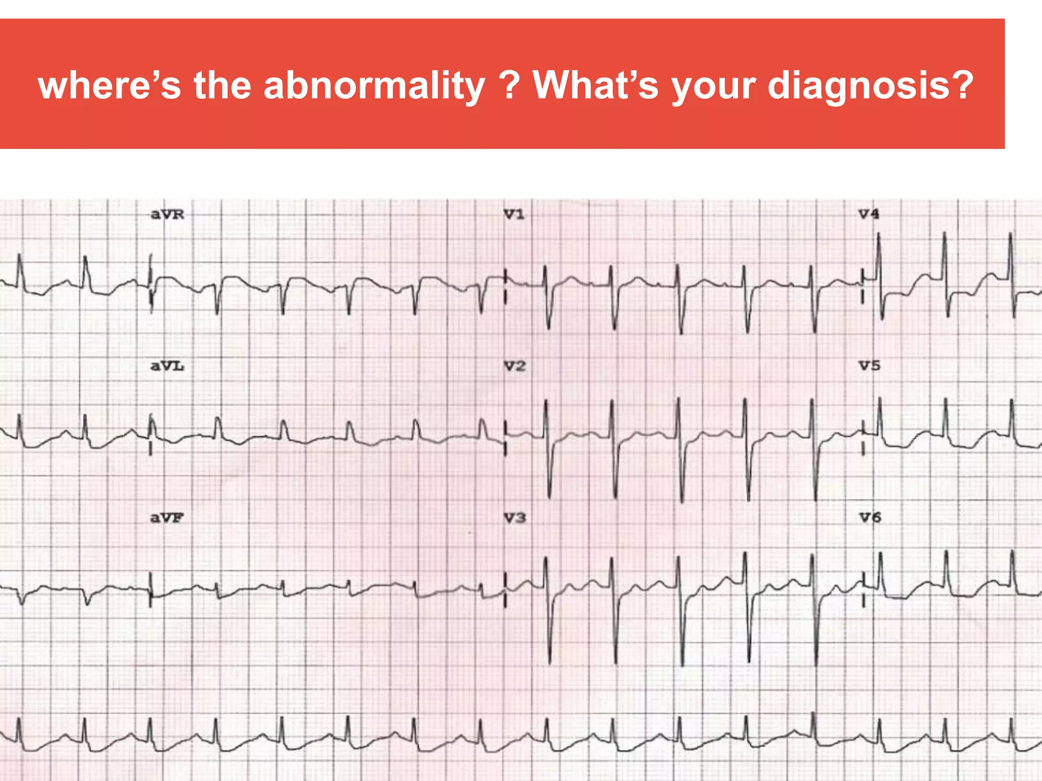 Ecg challenges | PPTX