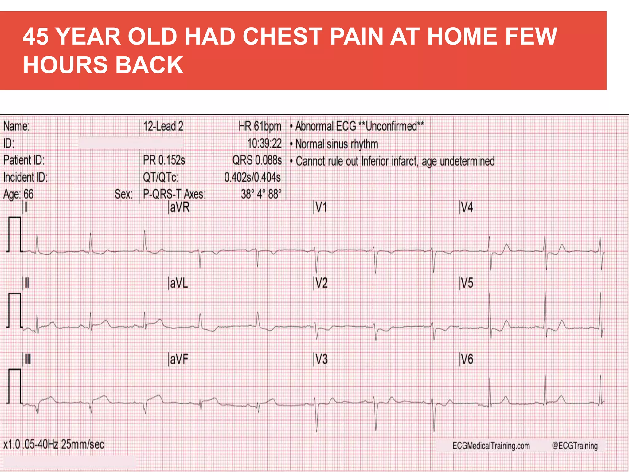 Ecg challenges | PPT