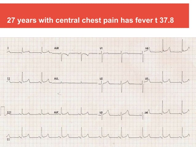 Ecg challenges | PPT